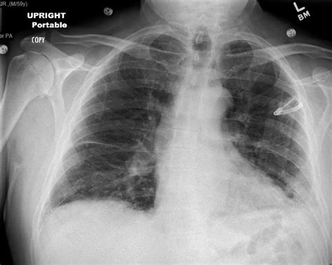 Treatment Of Pneumothorax With A Portable Thoracic Vent — Brown