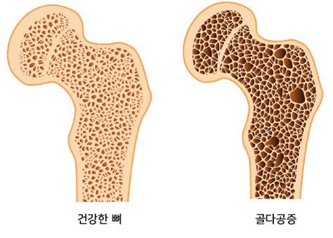 골다공증 증상 중증도와 검사 수치보는 법 치료 갓생