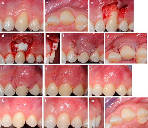 Cuspid Teeth Removal At Santos Long Blog