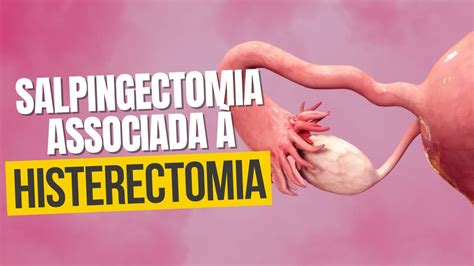 Quando é recomendada a salpingectomia associada à histerectomia YouTube