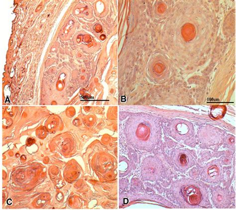 Photomicrograph Of The Cutaneous Infundibular Keratinizing Acanthoma