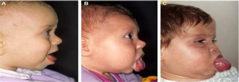 Various Manifestations Of Macroglossia In Bws Mild A Moderate B