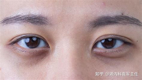 黑眼圈严重 肾虚？中医告诉你真相 知乎