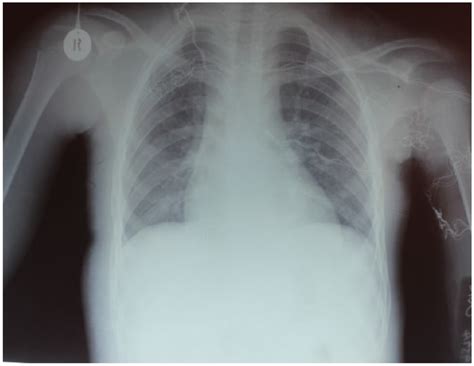 Posterioranterior Chest X Ray Showing Mediastinal Widening Download