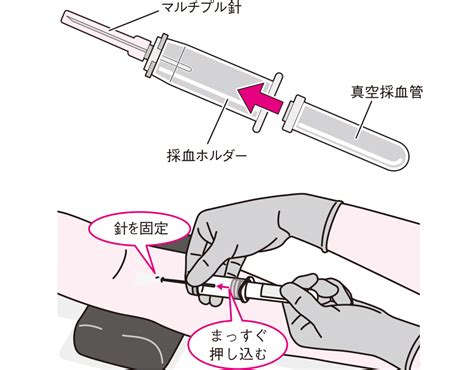 注射器以外に真空採血管を使う場合があるのはなぜ採血 看護roo カンゴルー