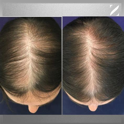 Hair Restoration Iprf זד מדיקל קלאב