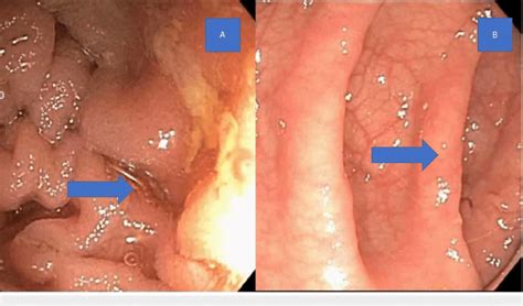 Terminal Ileum Colonoscopy Can You Live Without Your Large Intestine