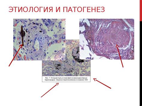 Пневмокониозы