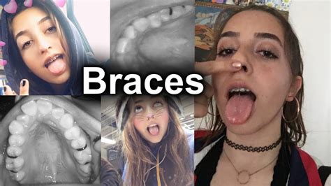 My Experience With Braces Youtube