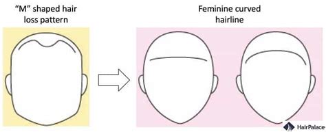 Transgender Hair Transplant What You Need To Know