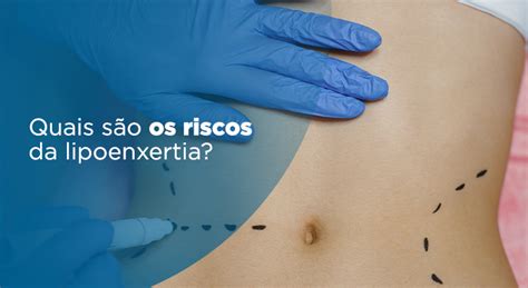 Foco Em Procedimentos Cirúrgicos Quais São Os Riscos Da Lipoenxertia