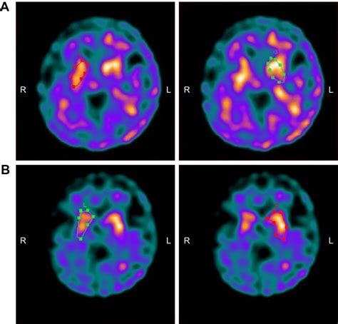 SpeCT Images Using Tc 99m TroDaT 1 Notes A SpeCT Images Under