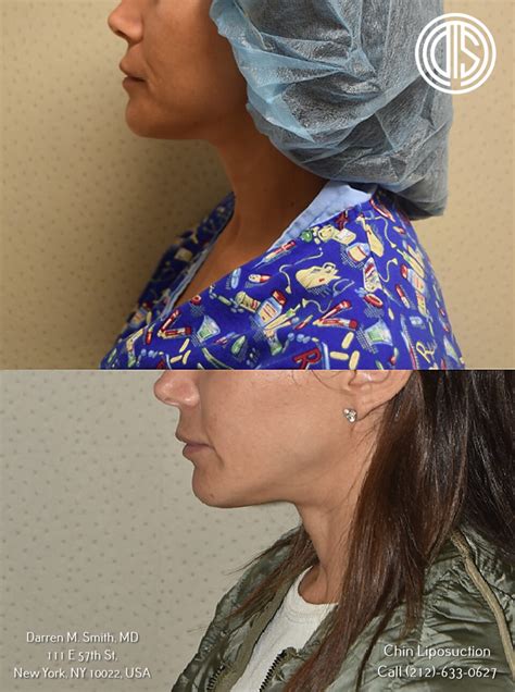 A Comprehensive Guide To The Causes Of Chin Liposuction Bad Results