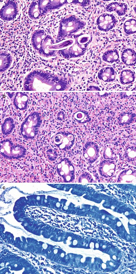 Multiple Opportunistic Infections Basicmedical Key