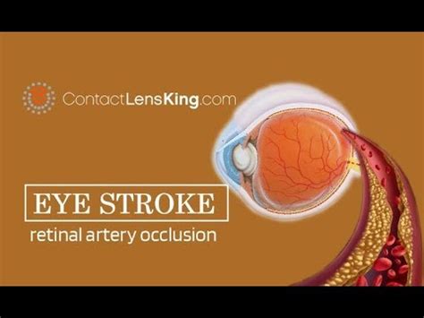 Eye Stroke Retinal Artery Occlusion Retinal Vein Occlusion What