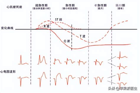 心电图判读（3）：典型的急性心肌梗死 知乎