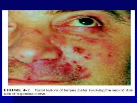 Infection Of Oral Mucosa Ppt