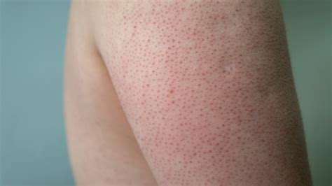 13 Best Keratosis Pilaris Treatments 2023 According To 48 Off