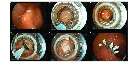 Pictures Of The Endoscopic Submucosal Resection With A Ligation Download Scientific Diagram