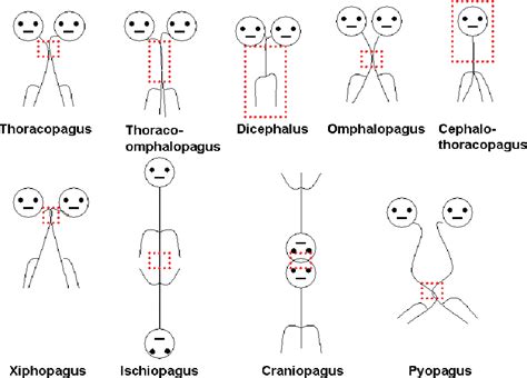 Figure 1 From Gnatho Thoracopagus Conjoined Twins With Near Di Symmetry A Case Report Of An