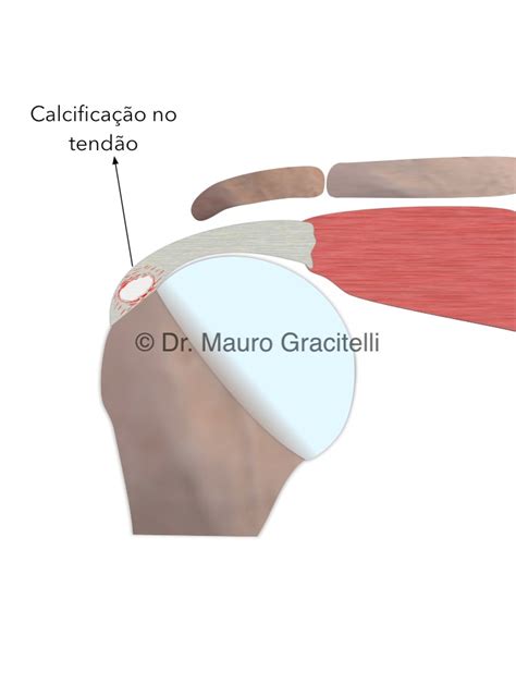 Causas De Dor No Ombro Dr Mauro Gracitelli