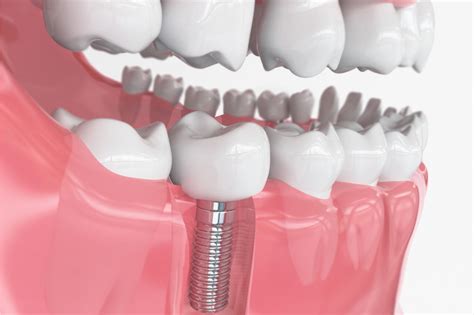 How Long Do Dental Implants Last How To Take Care Of Them
