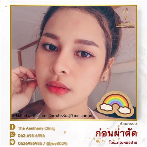 🌺รีวิว ศัลยกรรมตกแต่งจมูก🌺 🌺 The Aestheny Plastic Surgery Clinic นพ
