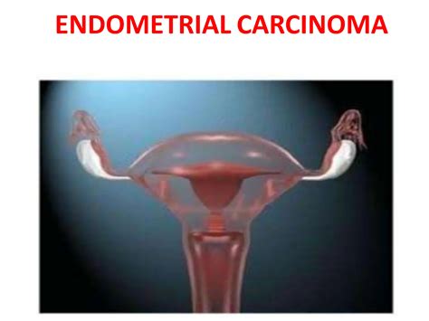Work Up A Case Of Endometrial Cancer Ppt Menopause Endocrine And