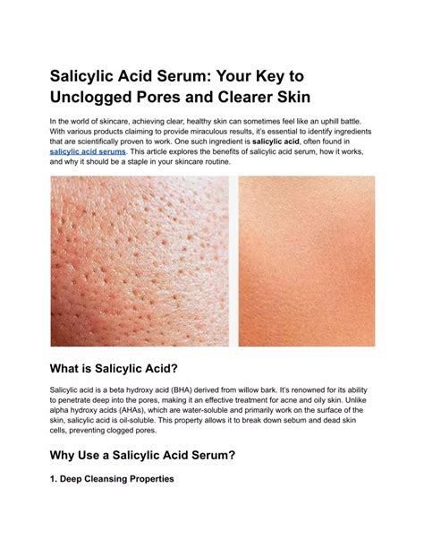 Ppt Salicylic Acid Serum Your Key To Unclogged Pores And Clearer Skin