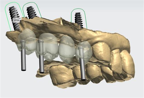 Caso clínico cirugía guiada de implantes Odontologia Global