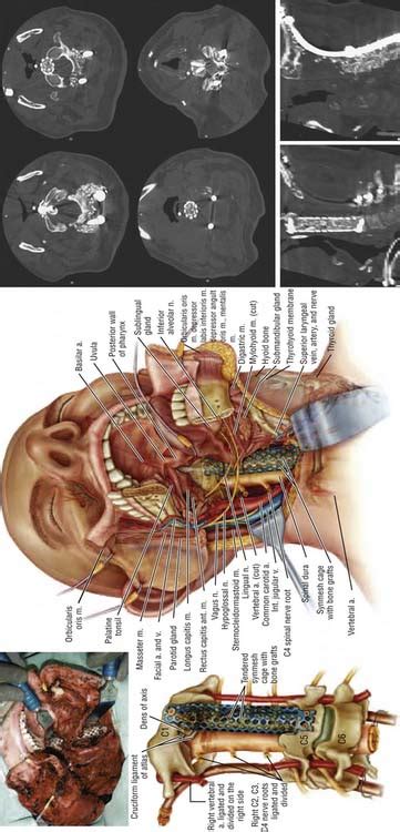 Tumors Of The Cervical Spine Neupsy Key