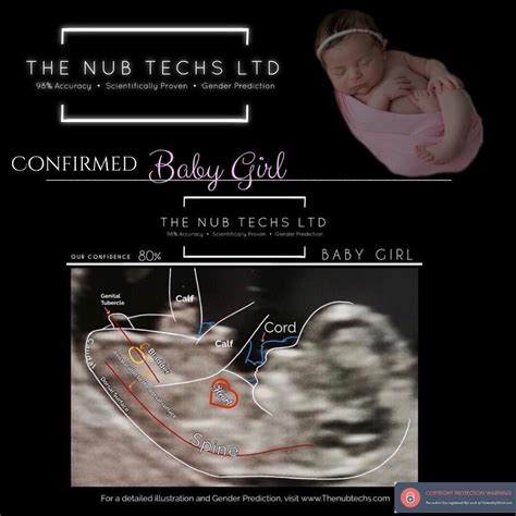 Baby Girls Identified As Early As 12 Weeks Using Nub Theory We