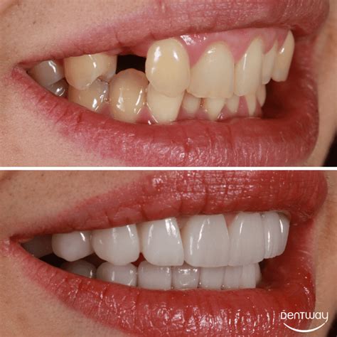 Multiple Tooth Implant Procedure At Once Cost In Istanbul Turkey