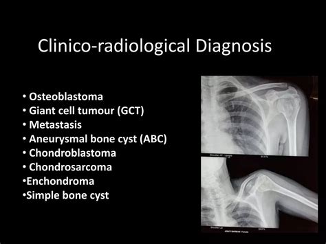 Chondrosarcoma Proximal Humerus Pptx Bone And Joint Conditions Diseases And Conditions