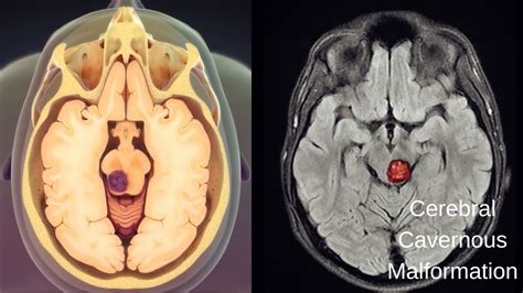 Cavernous Hemangioma Brain