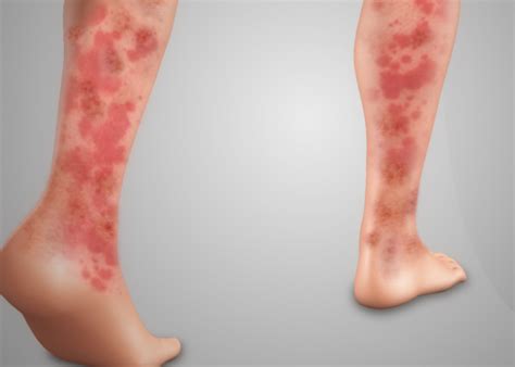Vasculitis And Vascular Autoimmune Conditions Raipur Chhattisgarh Dr