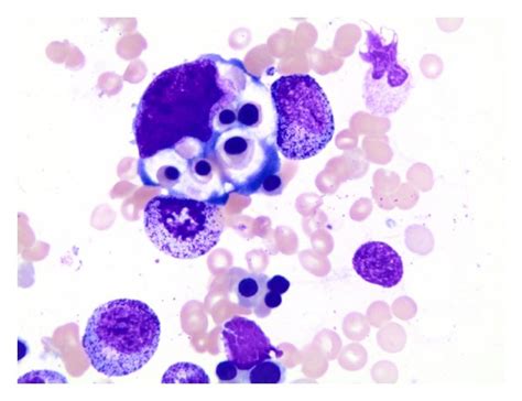 Distinct Histologic Features Of Macrophages Containing Other Cell