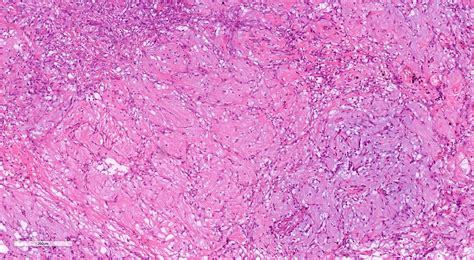 Pathology Outlines Primary Pulmonary Myxoid Sarcoma With Ewsr1creb1