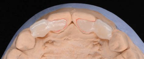 A Dark Horse Of Restorative Dentistry Decisions In Dentistry