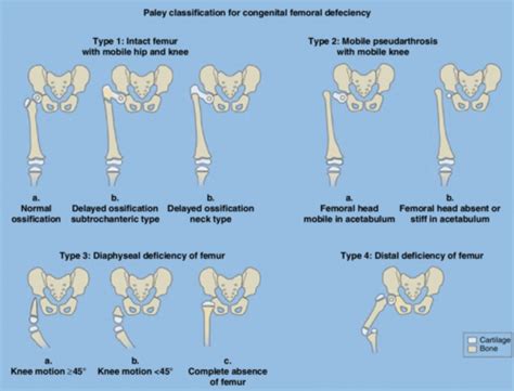 Congenital Femur Deficiency Classification © 2025