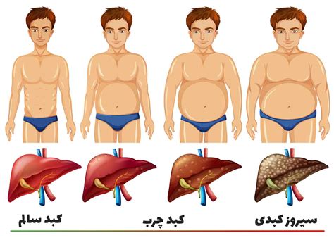 با بیماری کبد چرب و راه های بهبود و درمان آن بیشتر آشنا شوید عطاری