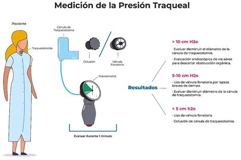 Traqueostomía En Pacientes Ventilados ¿para Qué La Hacemos La Casa