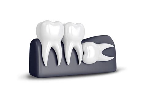 Toot Extraction Dubai Wisdom Teeth Removal The One Clinic