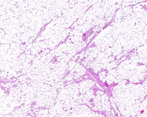 Elizabeth Montgomery Md On Twitter A Classic Atypical Lipomatous Tumor