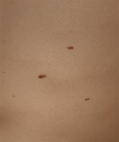 Please Tell Me Its Not Melanoma Rmelanoma