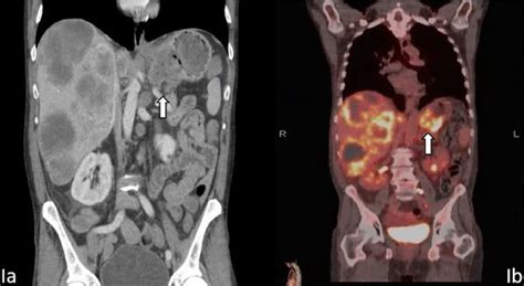 A Ct Demonstrating Gastric Mass In The Lesser Curvature Arrow With