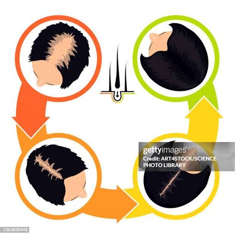 Receding Hairline Woman High Res Illustrations Getty Images