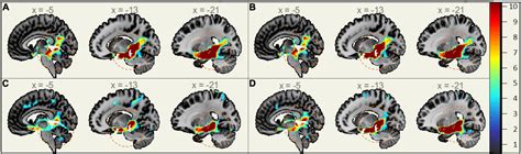 Frontiers Sex Differences In Brain Functional Connectivity Of Hippocampus In Mild Cognitive