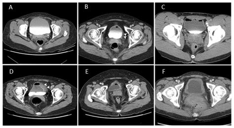 Representative Computed Tomography Ct Scan Bladder Images In Patients