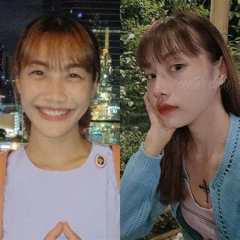 รีวิว เสริมจมูก Cender Clinic